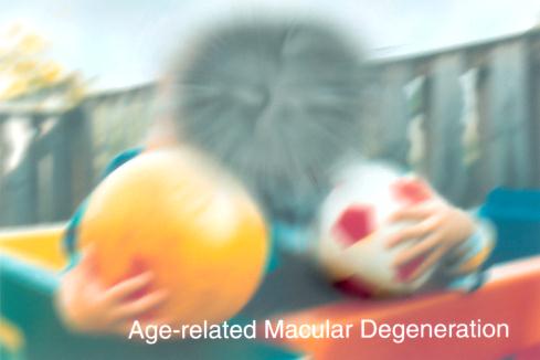 Age-Related Macular Degeneration (AMD) Symptoms and Treatments for ...